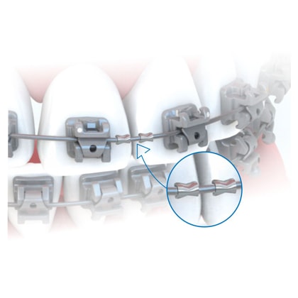 Stop Metalíco Para Arcos Redondos - Orthometric | Produto Odontológico ...